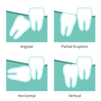 Wisdom Tooth Removal | Neutral Bay | Whites Dental Care